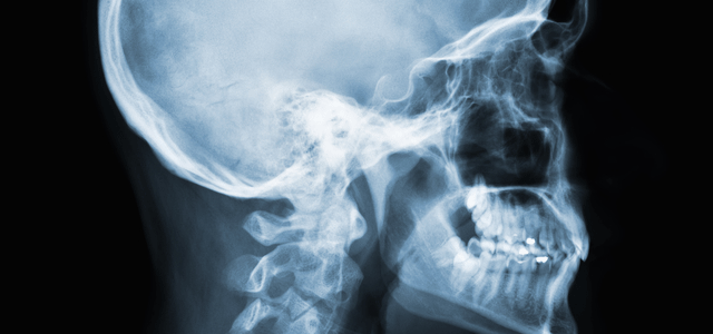 What Is A CEPH X ray And Do I Need One What Is A CEPH X ray And Do I Need One